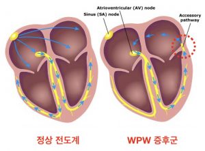 WPW 증후군 | 김형태교수의 세상사는 이야기
